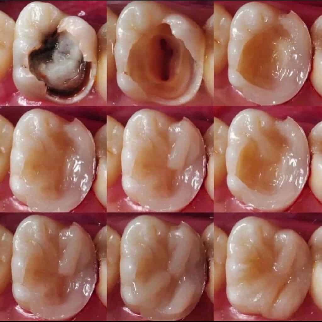 Composite Tooth Color Dental Filling